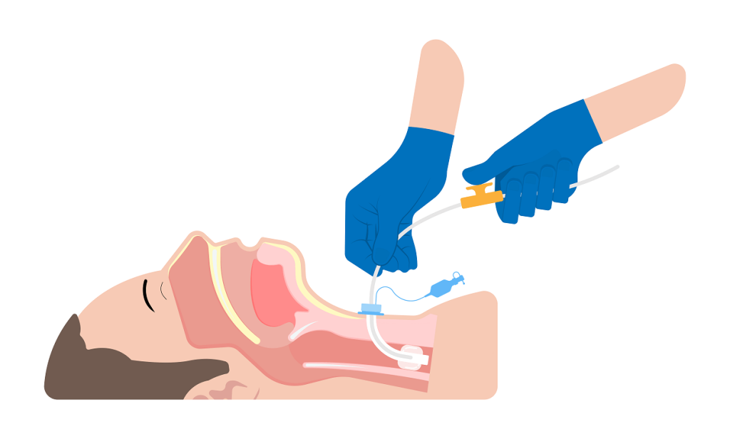 Suctioning care – Valour Private Limited